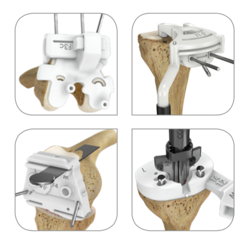 Custom made Knee Replacements Knee Replacements In London Custom made Knee Replacements Knee Replacements In London